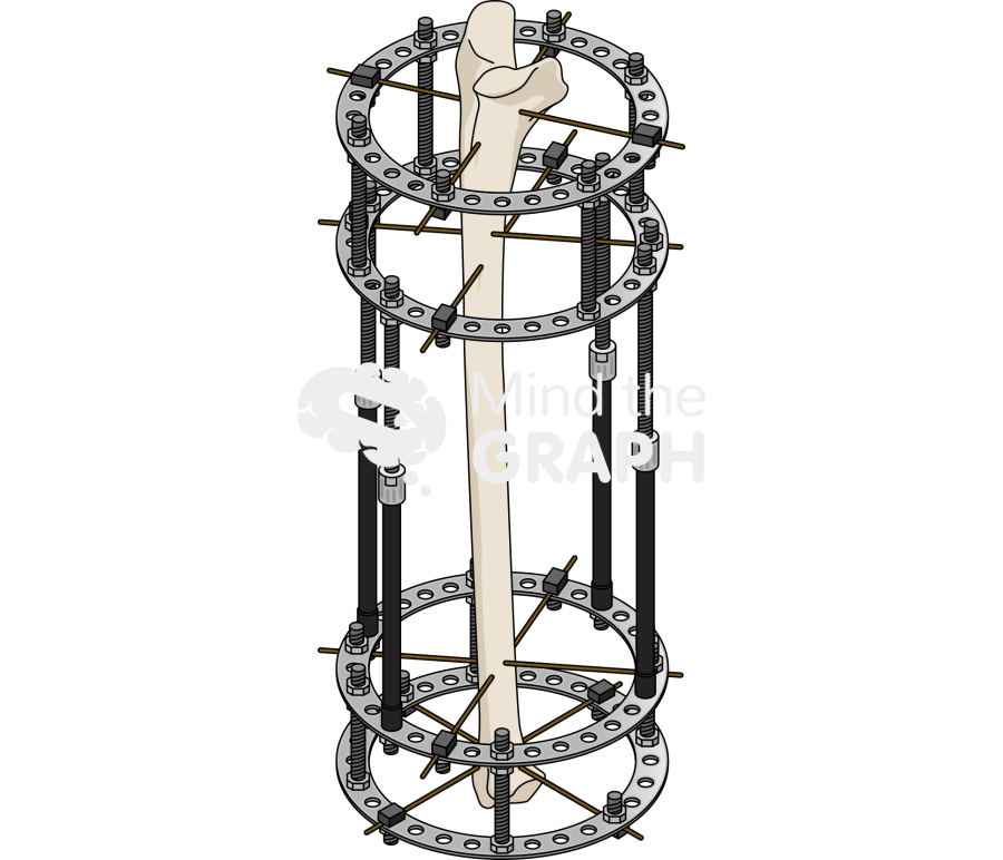 Ilizarov fixator equipment