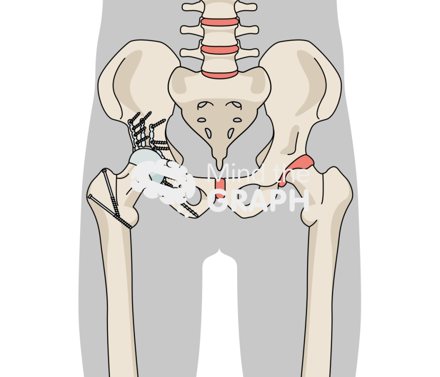 Acetabular fracture repair body