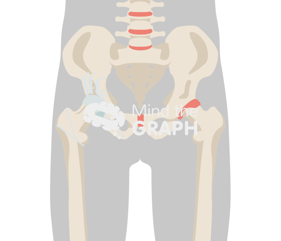 Acetabular fracture repair body