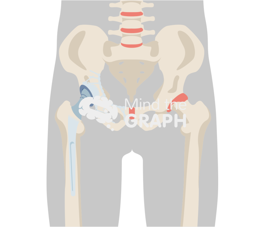 Free Acute acetabular fracture repair total hip arthroplasty body Icons ...