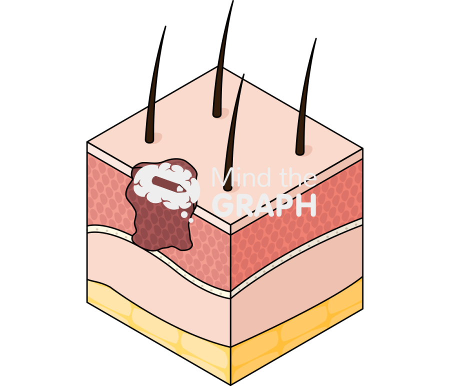 Free Basal Cell Carcinoma Skin Perspective Icons Symbols Pictures And Images Mind The Graph