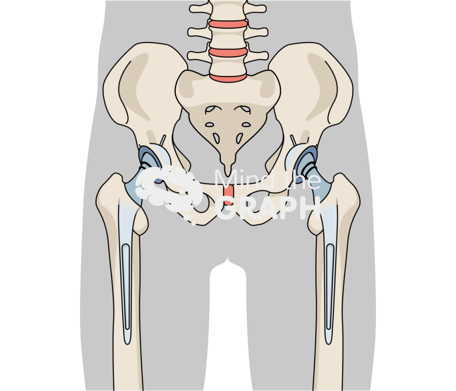 Free Bilateral Total Hip Arthroplasty Body Icons Symbols Pictures Free Bilateral Total Hip Arthroplasty Body Icons Symbols Pictures