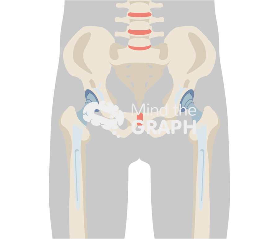 Free Bilateral Total Hip Arthroplasty Body Icons Symbols Pictures Free Bilateral Total Hip Arthroplasty Body Icons Symbols Pictures