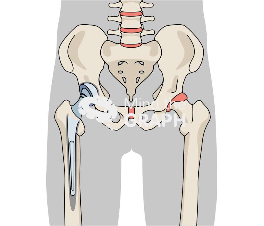 Free Cemented total hip arthroplasty body Icons, Symbols, Pictures, and ...