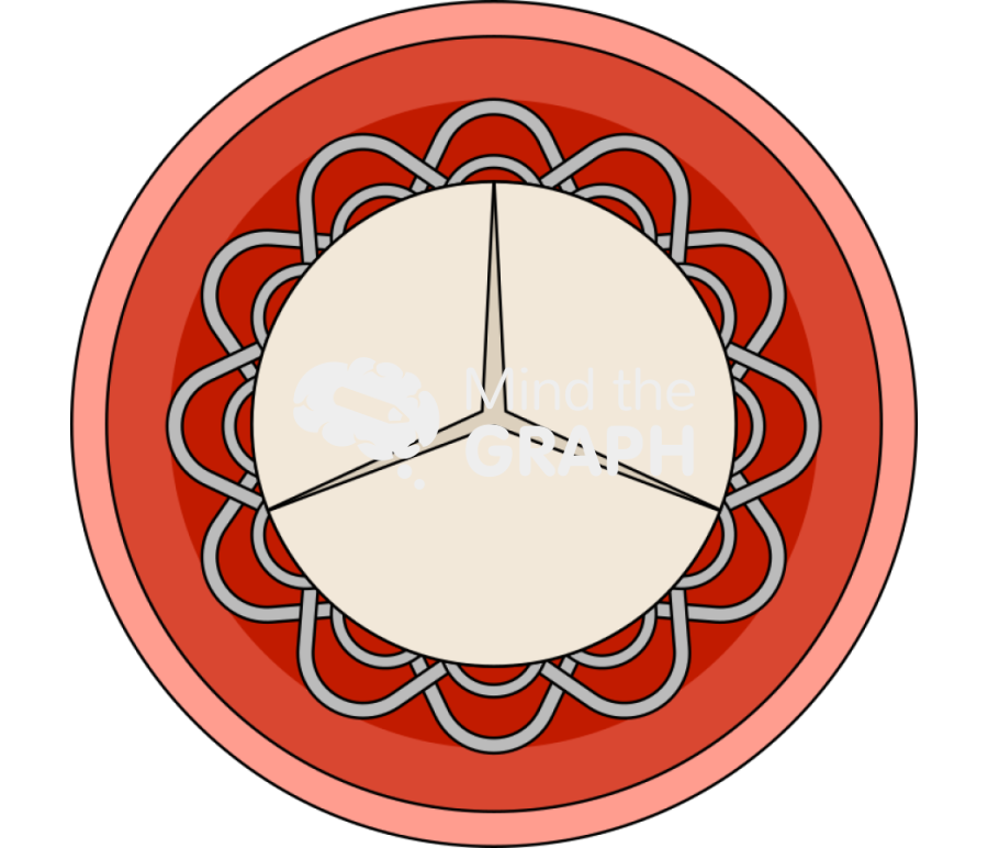 Free Coronary obstruction transcatheter aortic valve replacement 26mm ...
