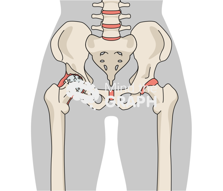 Degenerative joint disease hip animation body