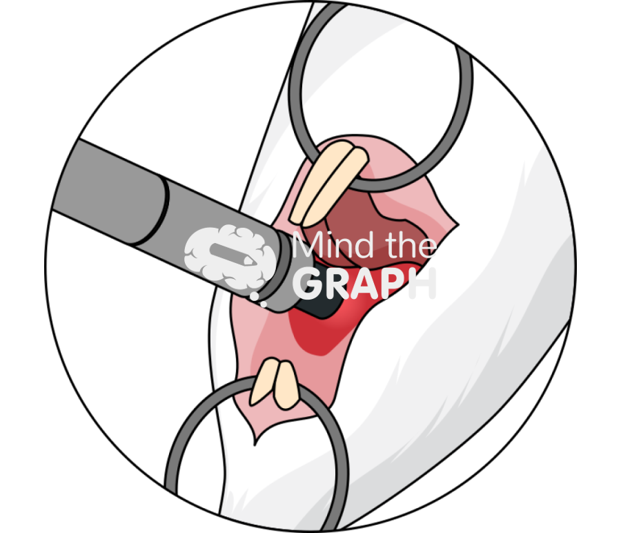 Diode laser probe photobiomodulation