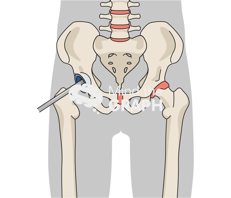 Direct anterior cup placement body