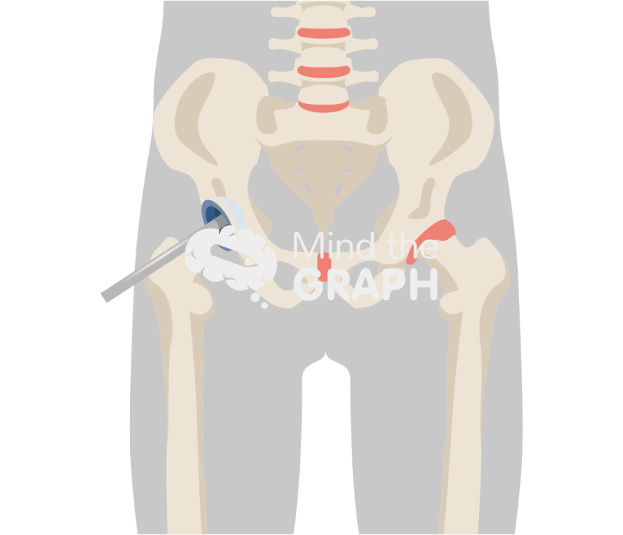 Direct anterior cup placement body