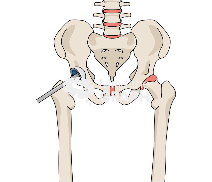 Free Direct anterior cup placement bone full Icons, Symbols, Pictures ...