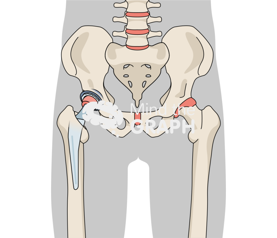 Free Dual Mobility Total Hip Arthroplasty Body Icons Symbols Pictures And Images Mind The Graph