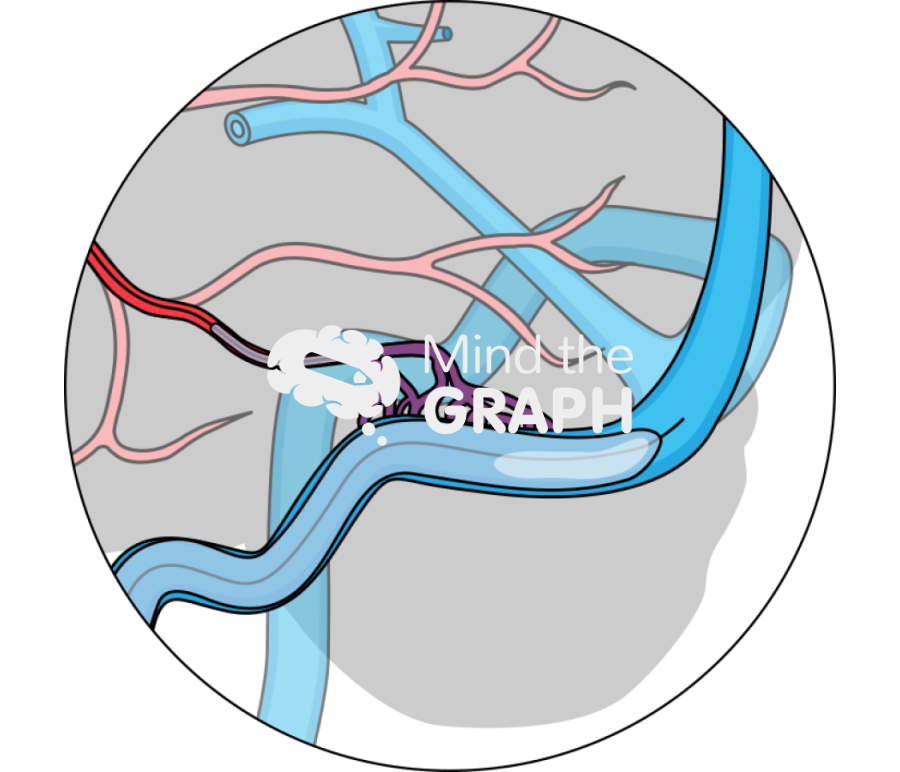 Free Dural arteriovenous fistula embolization liquid embolic 2 zoom ...