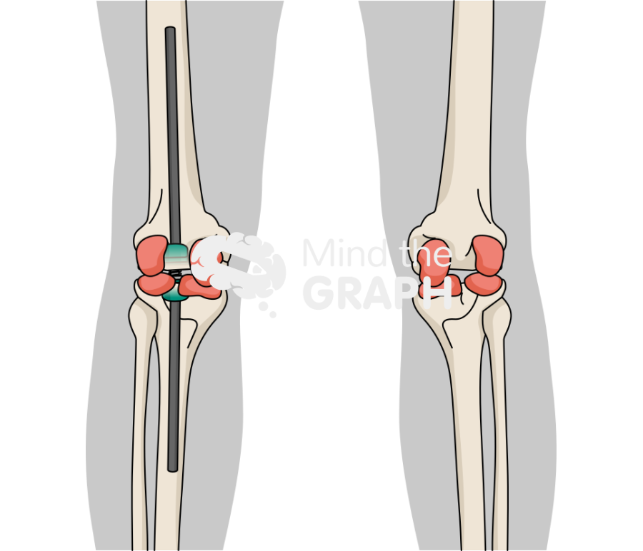 Free Exfix abx spacer anteroposterior body Icons, Symbols, Pictures ...