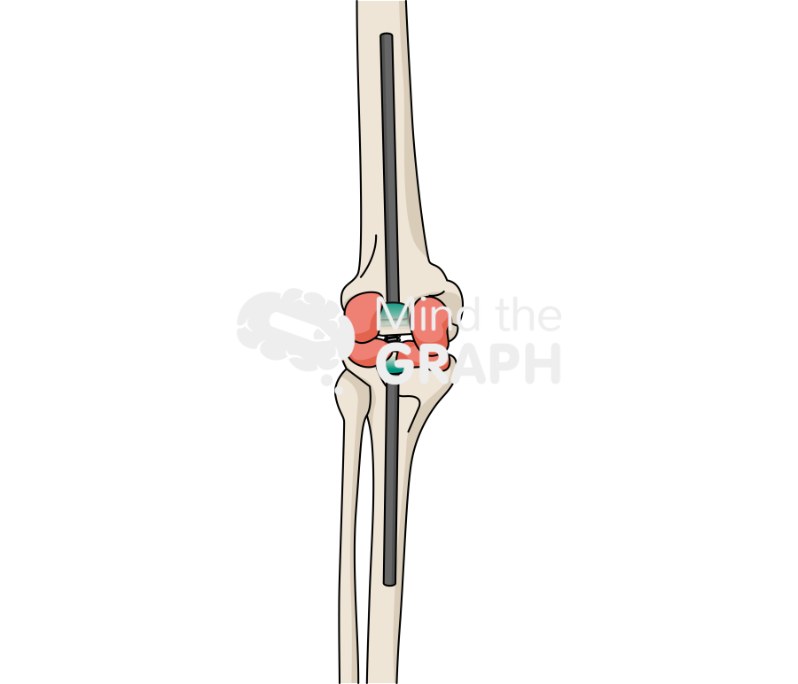 Free Exfix abx spacer anteroposterior bone full Icons, Symbols ...