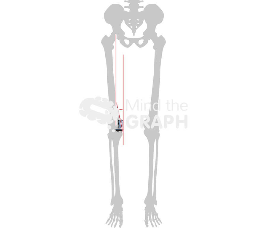 Free Femoral alignment unicompartmental knee arthroplasty bone Icons ...