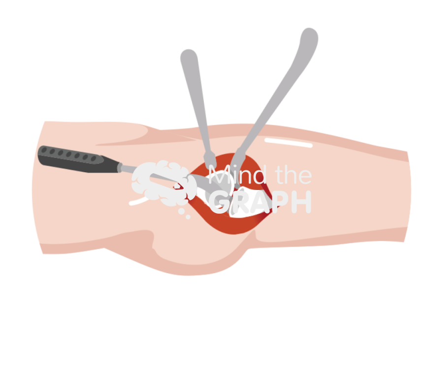 Femoral exposure direct anterior approach zoom Femoral exposure direct anterior approach zoom