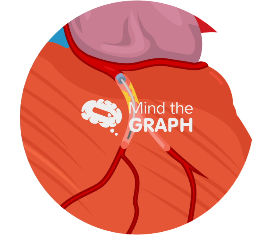 Free Heart left main percutaneous coronary intervention zoom Icons ...