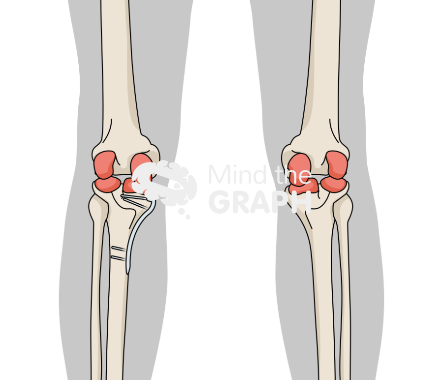 High tibial osteotomy anterior posterior body