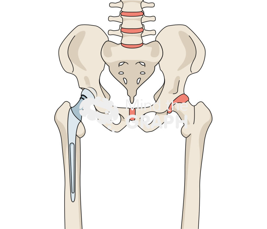 Free Hip uncemented hemiarthroplasty bone full Icons, Symbols, Pictures ...