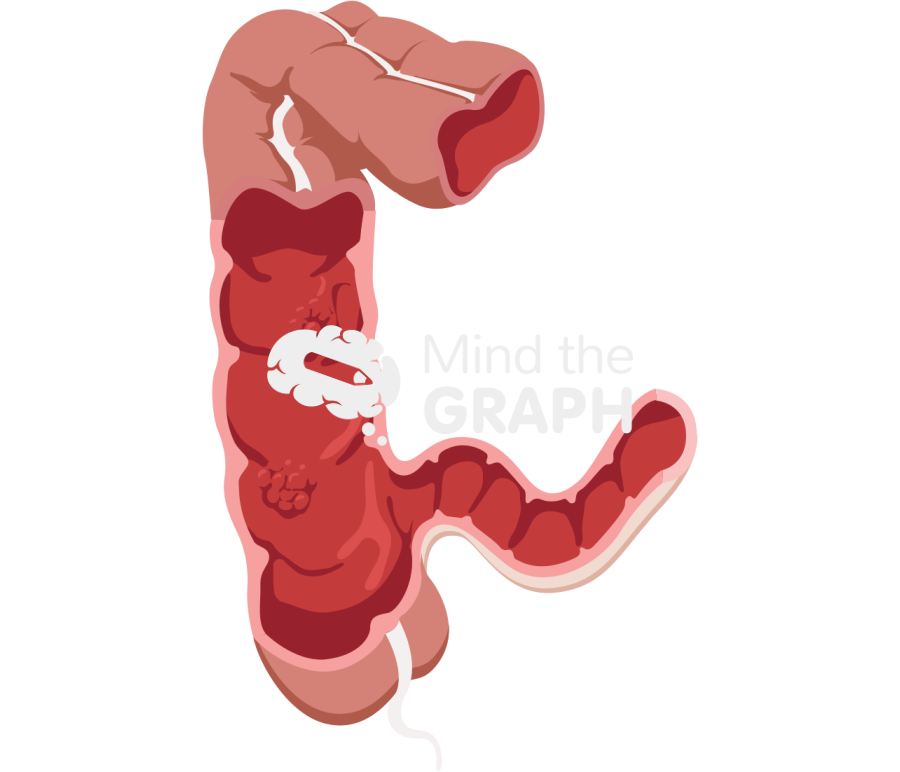 Free Intestine polyps cut Icons, Symbols, Pictures, and Images | Mind ...