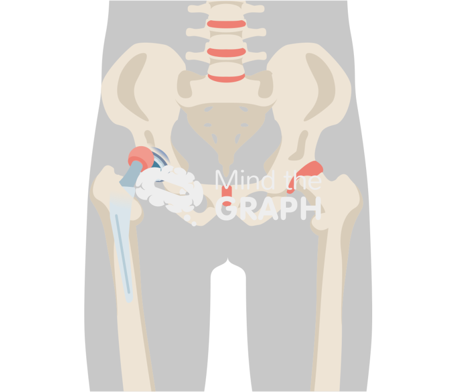 Free Intraprosthetic Dislocation Dual Mobility Icons Symbols Pictures