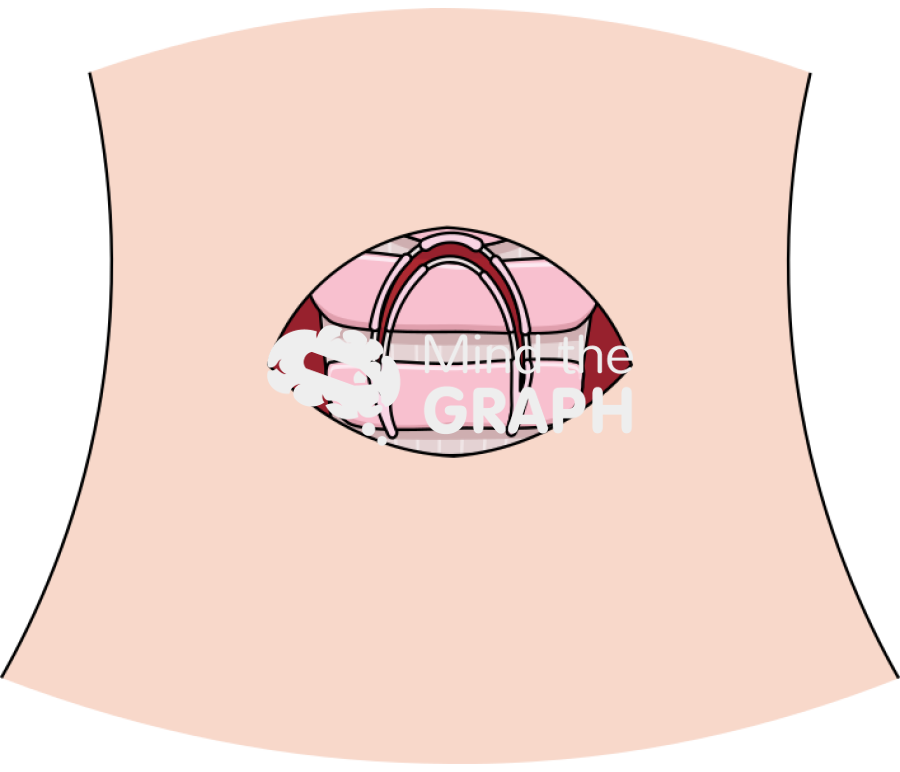 Free Inverted u incision tracheostomy Icons, Symbols, Pictures, and ...