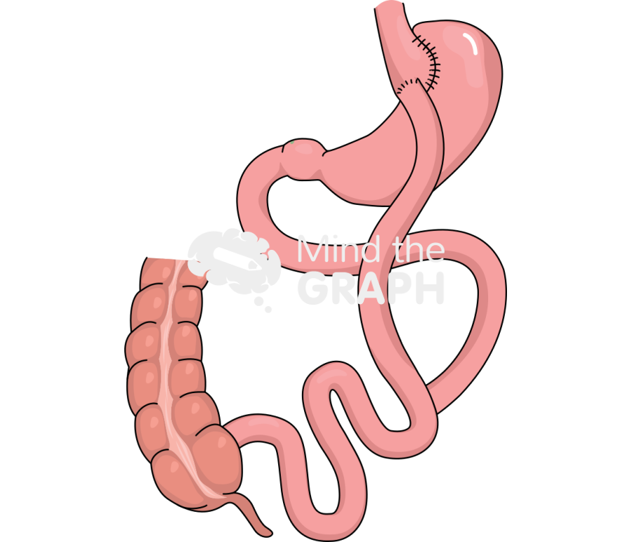 Free Nissen bypass 2 Icons, Symbols, Pictures, and Images | Mind the Graph