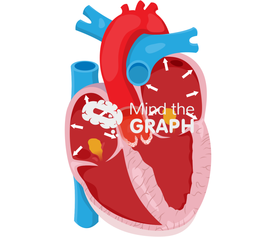 Paradoxical low flow low gradient severe aortic stenosis