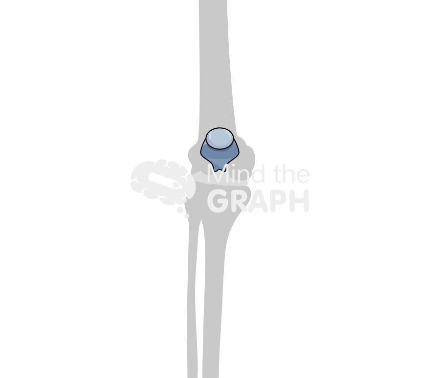 Free Patellofemoral arthroplasty bone Icons, Symbols, Pictures, and ...