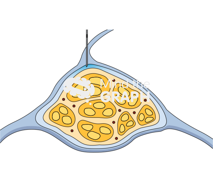 Perineural dexamethasone peripheral nerve block