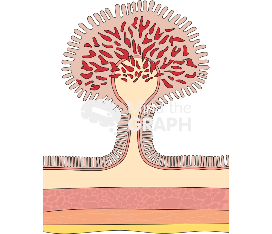 Free Polyp haggitt pedunculated adenoma Icons, Symbols, Pictures, and ...