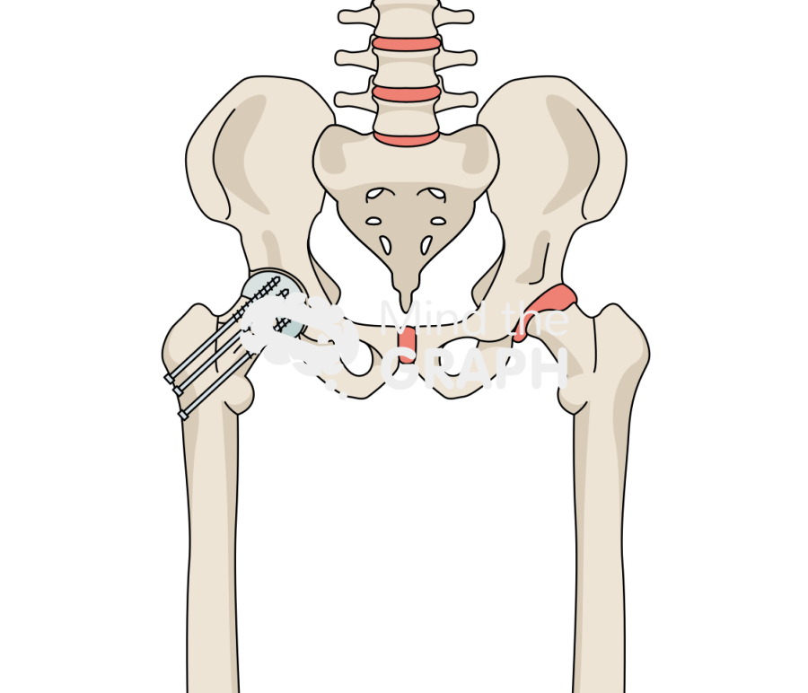 Free Post traumatic hip osteoarthritis screws bone full Icons, Symbols ...