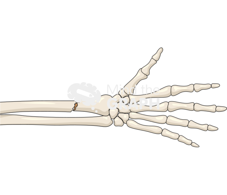Radius fracture 2