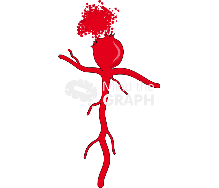 Free Saccular aneurysm open 2 Icons, Symbols, Pictures, and Images ...