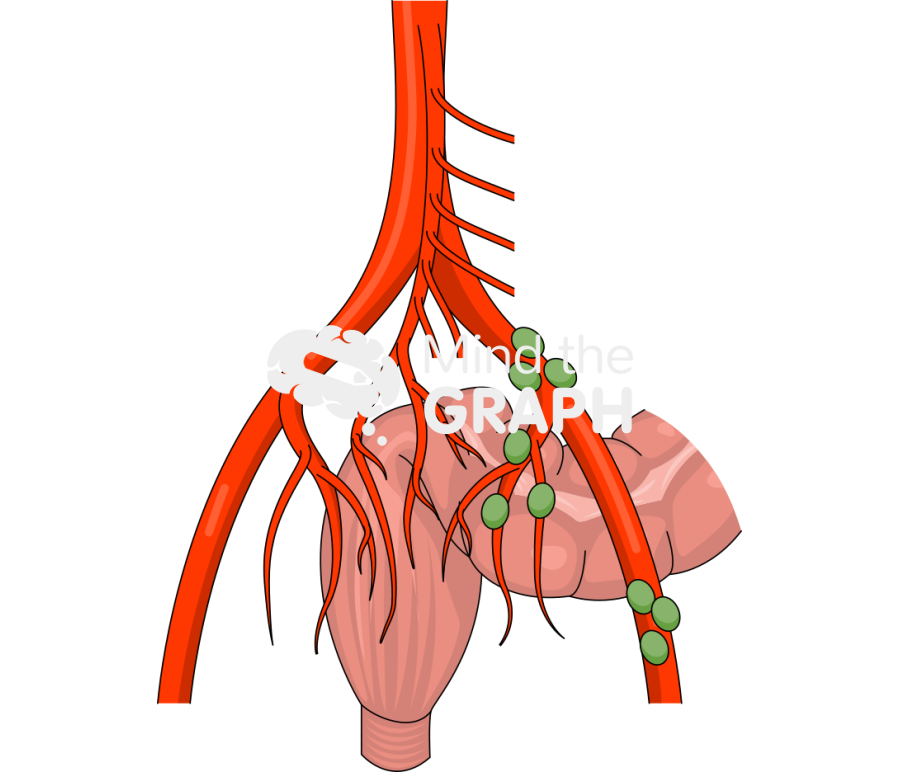 Schematic representation pelvic right lymph node