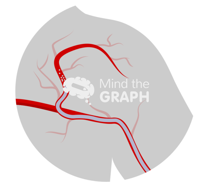 Free Shoulder embolization 1 Icons, Symbols, Pictures, and Images ...