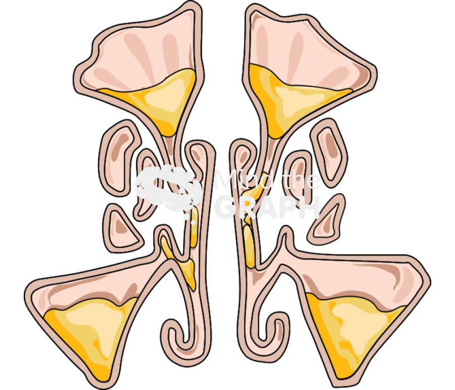 Free Sinusitis Icons Symbols Pictures And Images Mind The Graph free-sinusitis-icons-symbols-pictures-and-images-mind-the-graph