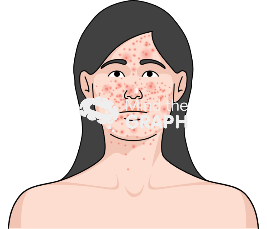 Systemic lupus erythematosus