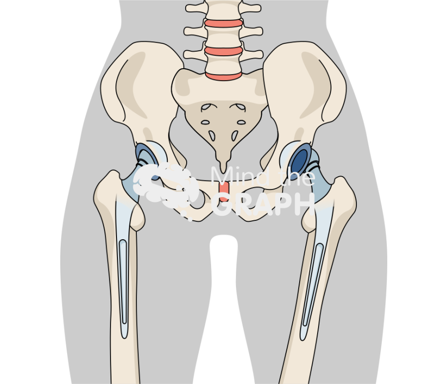Free Total Hip Arthroplasty Dislocation Body Icons Symbols Pictures Free Total Hip Arthroplasty Dislocation Body Icons Symbols Pictures