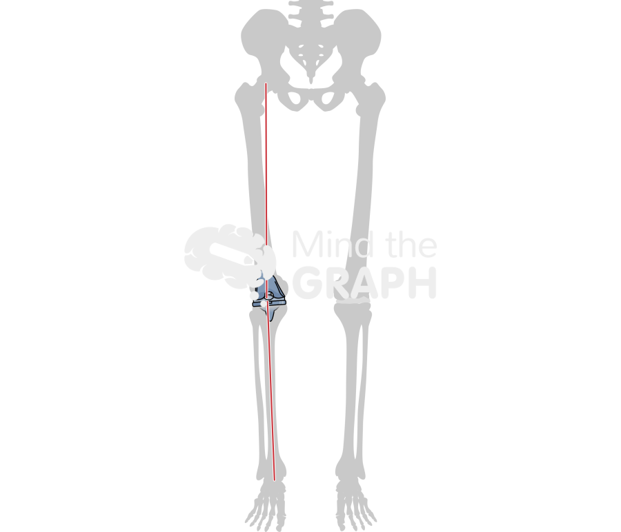 Free Total knee arthroplasty alignment bone Icons, Symbols, Pictures ...