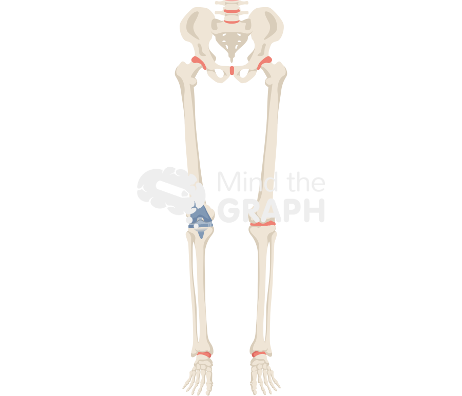 Free Total knee arthroplasty alignment bone full Icons, Symbols ...
