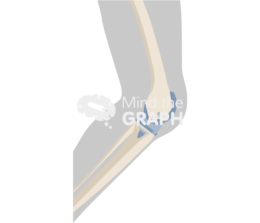 Total knee arthroplasty cruciate retaining body
