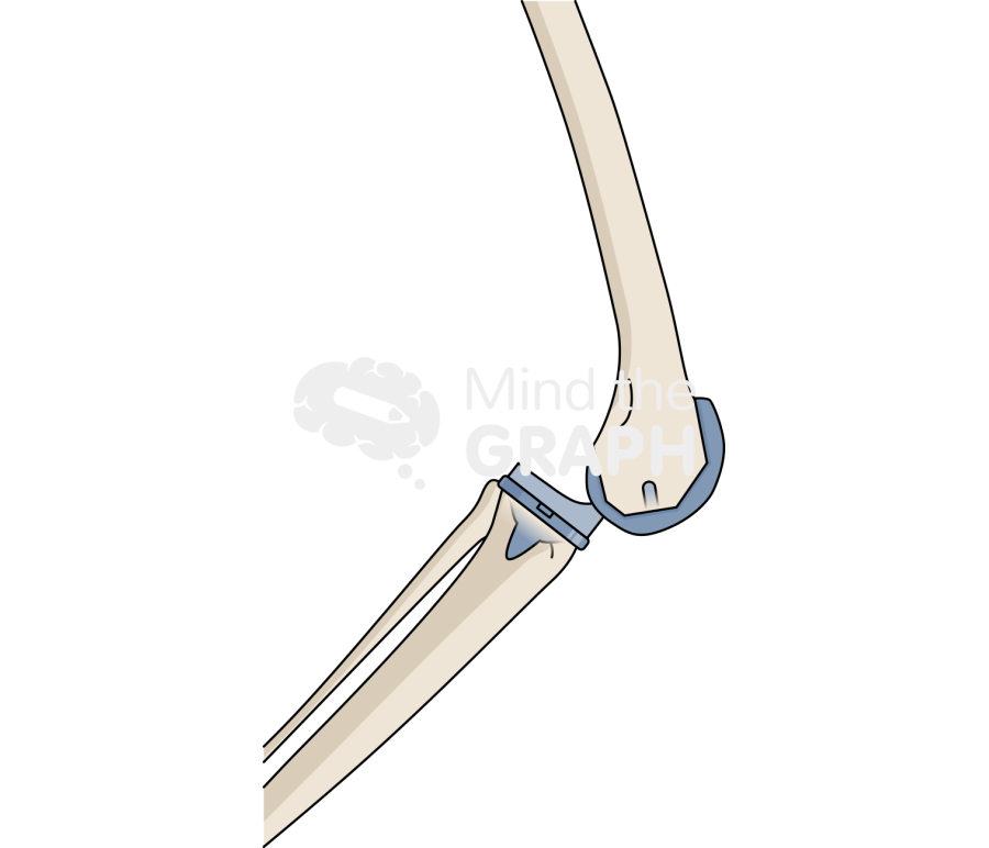 Free Total knee arthroplasty dislocation bone full Icons, Symbols ...