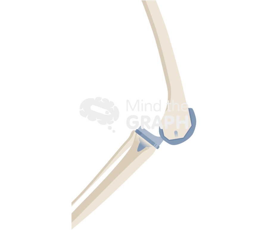 Free Total knee arthroplasty dislocation bone full Icons, Symbols ...