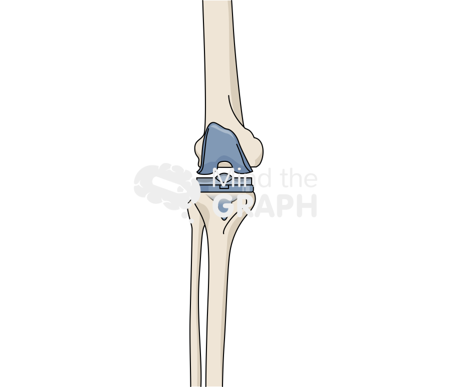 Free Total knee arthroplasty instability bone full Icons, Symbols ...