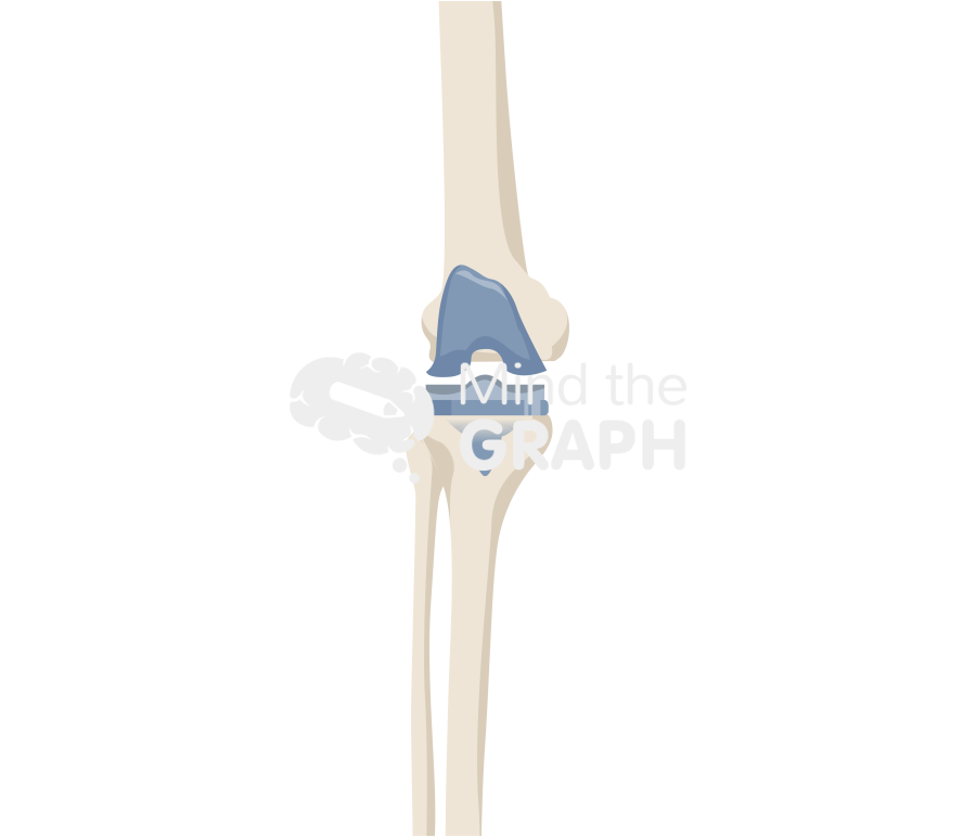 Free Total knee arthroplasty instability bone full Icons, Symbols ...