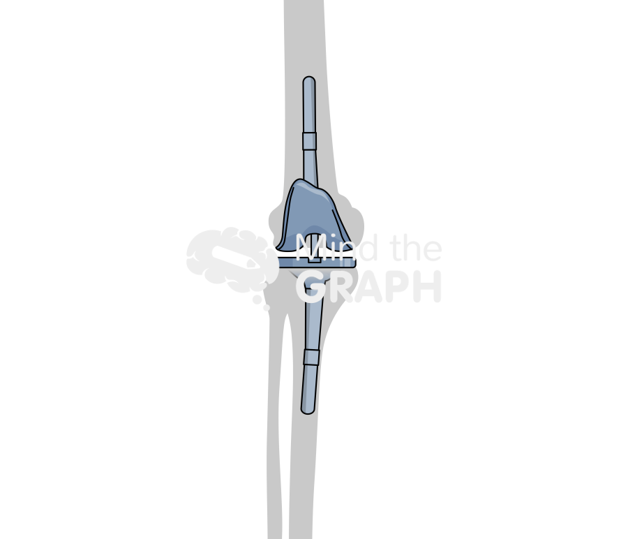 Total knee arthroplasty revision approach bone