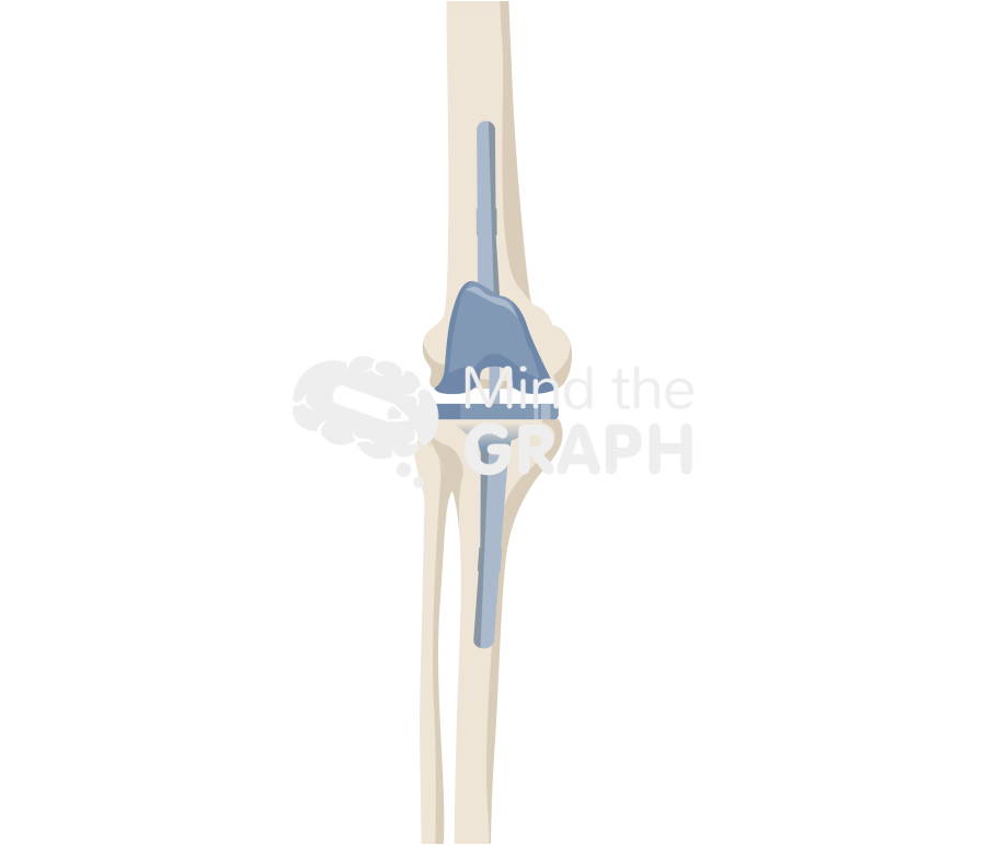 Total knee arthroplasty revision approach bone full