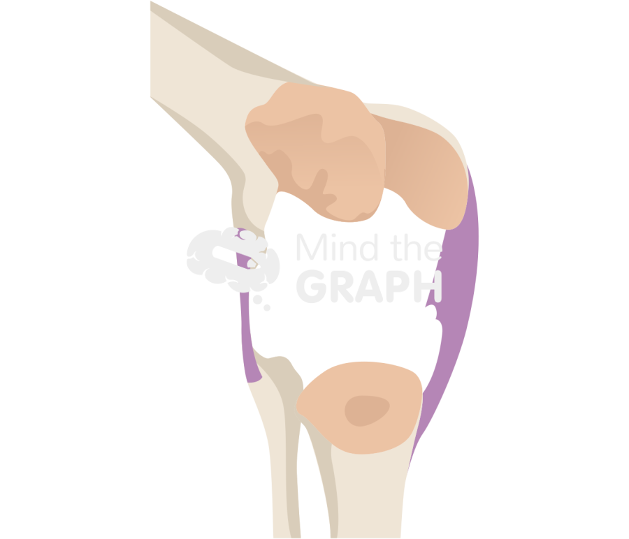 Total knee arthroplasty revision bone loss4