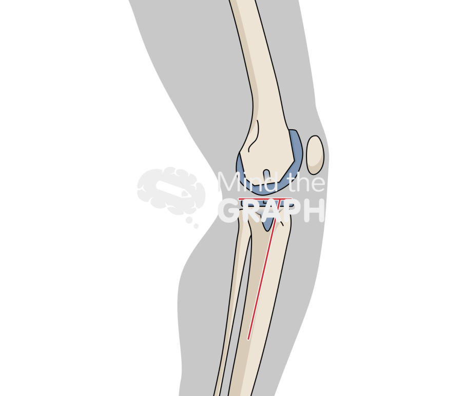 Free Total knee arthroplasty tibial slope body Icons, Symbols, Pictures ...